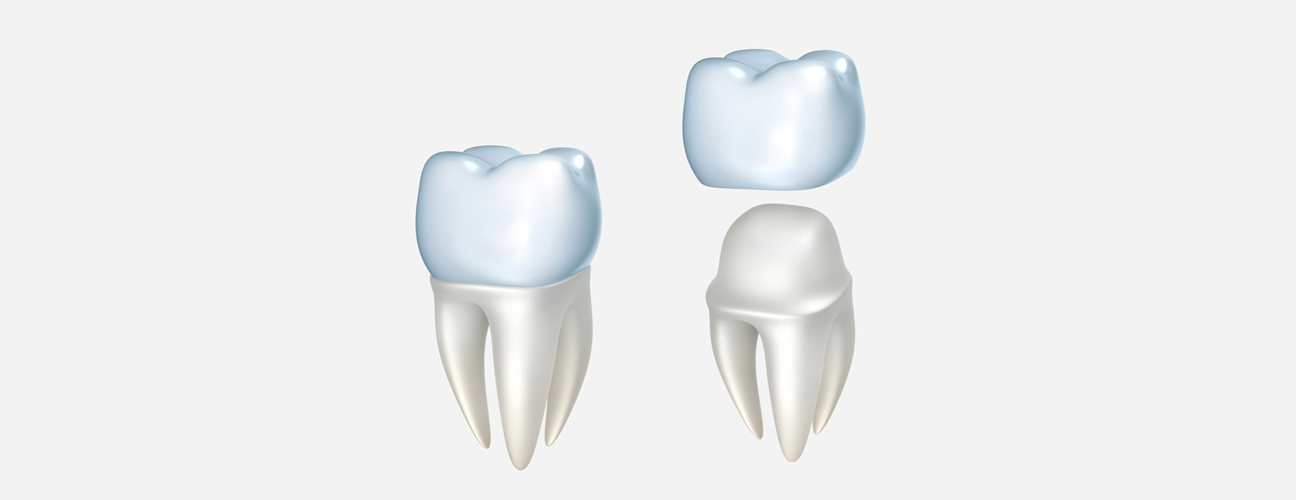 Dental Crowns Treatment in Stittsville ON - A2 Dental